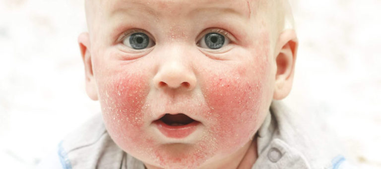 Un guide pour soulager l'eczéma de votre bébé